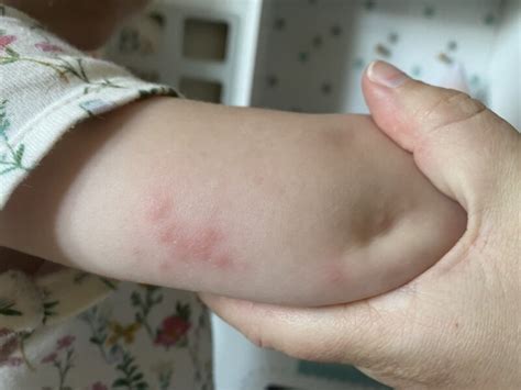 Chicken Pox Flea Bites Bed Bugs Mosquitos Mumsnet