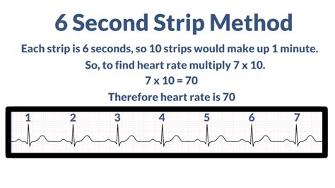 Interpreting ECG Strips Nursing Unraveled
