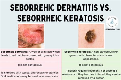 Seborrheic Dermatitis Vs Seborrheic Keratosis With Pictures