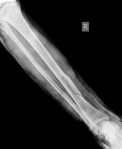 X Ray Of Arm