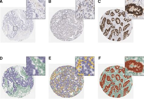 p53 immunohistochemistry in colon cancer tissue microarrays and download scientific diagram