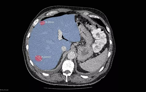 liver and liver tumor segmentation and analysis