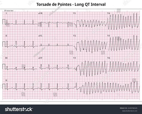 1 389 Lead Ecg Images Stock Photos Vectors Shutterstock