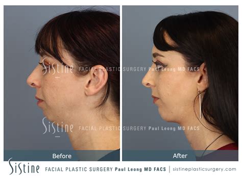 Chin Jaw And Neck Before And After 02 Sistine Facial Plastic Surgery