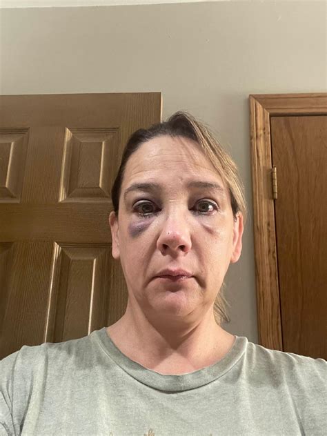 Photos Show Missouri Mom Michelle Audos Face After Teen Girl Attack
