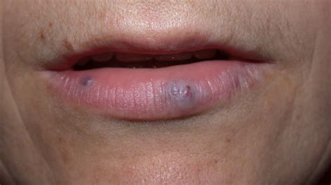 How To Get Rid Dark Spots On Lips Lipstutorial Org