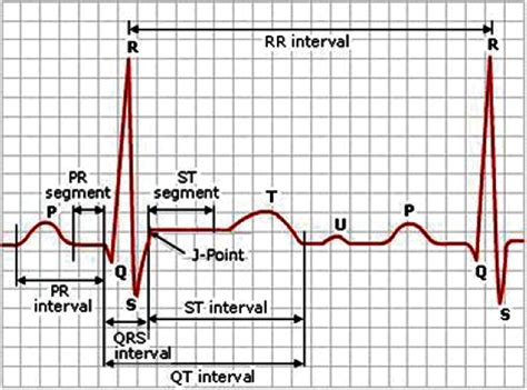 automatic heart disease detection by classification of ventricular arrhythmias on ecg using