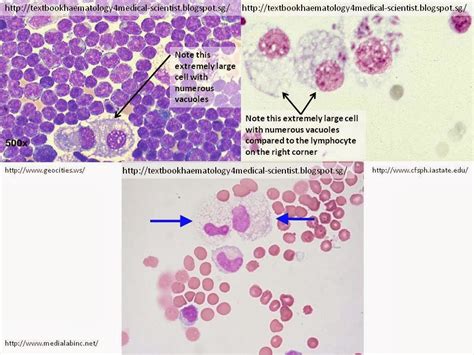 Haematology In A Nutshell Hematological Cells In Fluid Analysis