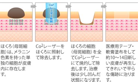 ほくろレーザー除去保険外診療赤坂メディカルmクリニック