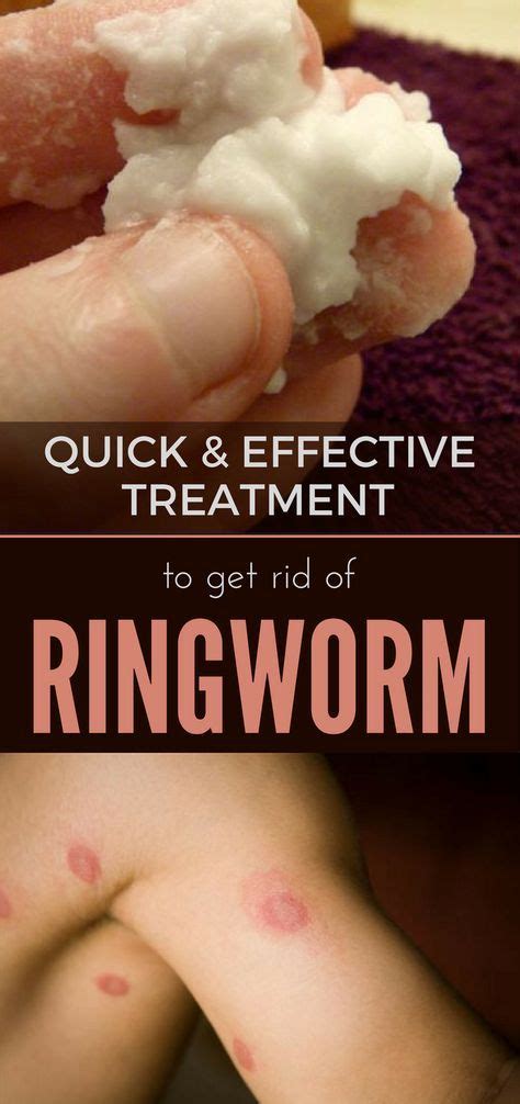 Quick And Effective Treatment To Get Rid Of Ringworm Home Remedies For Ringworm Ringworm