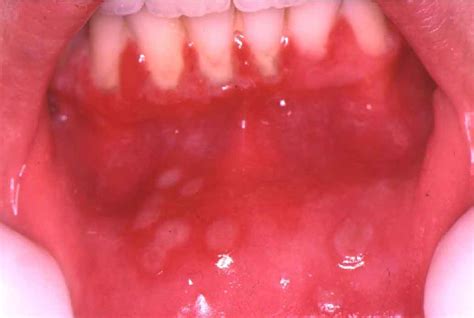 Herpes Labialis Inside Mouth