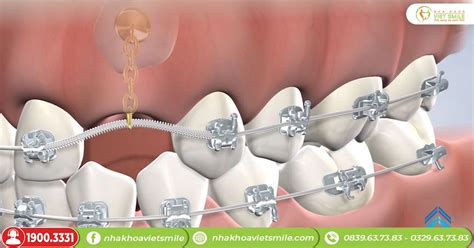 Kéo răng ngầm mất bao lâu Những điều cần biết 2024