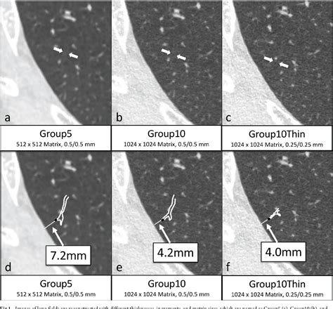 figure 1 from evaluation of peripheral bronchiole visualization using model based iterative