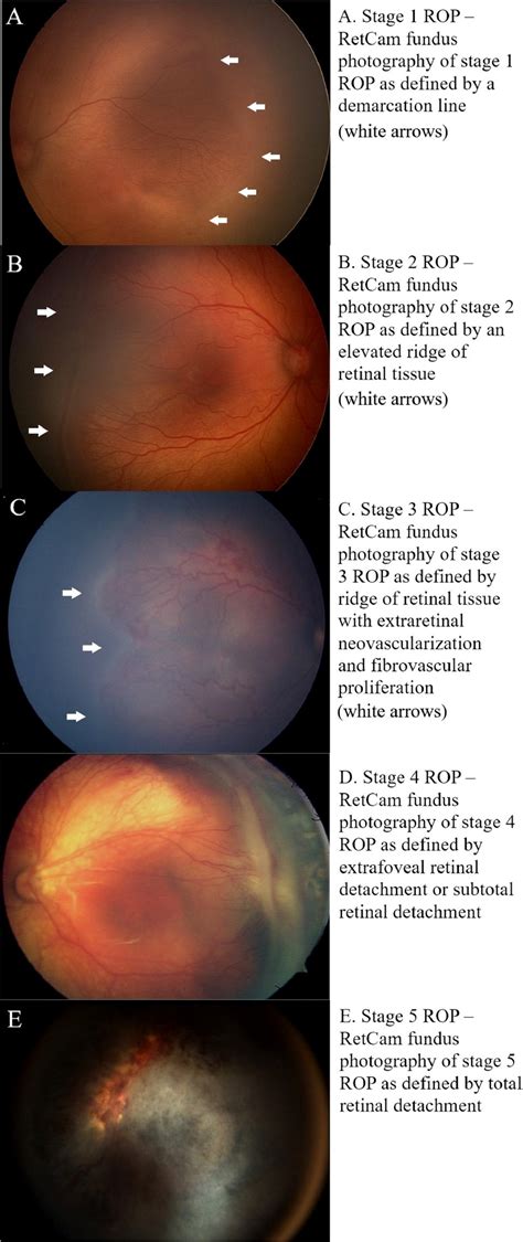 retinopathy of prematurity advances in the screening and treatment of retinopathy of