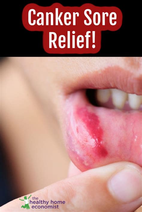 How To Stop Canker Sores Forever Healthy Home Economist
