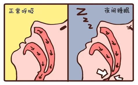 什么是混合性睡眠呼吸暂停综合征 知乎