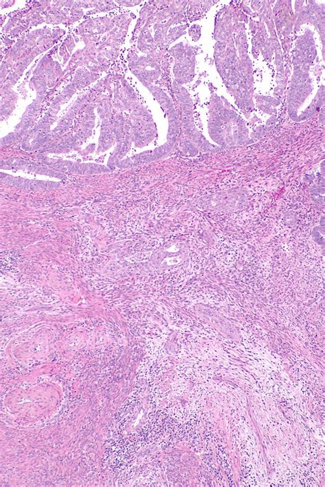 Microcystic Elongated And Fragmented Glands In Endometrioid Endometrial Carcinoma Libre Pathology