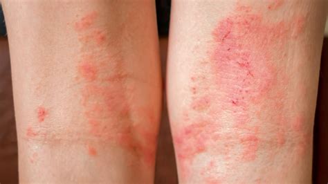 Dermatitis Causes Symptoms Diagnosis Treatment Prevention And More Healthroid