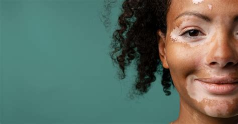 What Is Vitiligo Top 5 Vitiligo Types Causes And How To Manage It Derma Essentia