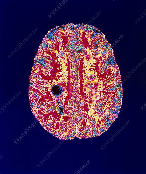 Col MRI Scan Of A Brain With Multiple Sclerosis Stock Image M210
