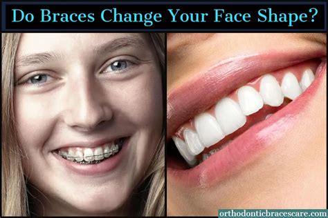 How To Make Your Lips Look Bigger With Braces Lipstutorial Org