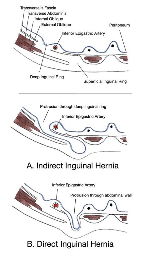 Inguinal Hernia Indirect Accessmedicine Mcgraw Hill M