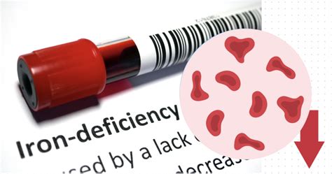 Surprising Causes Of Iron Deficiency Discovery Body