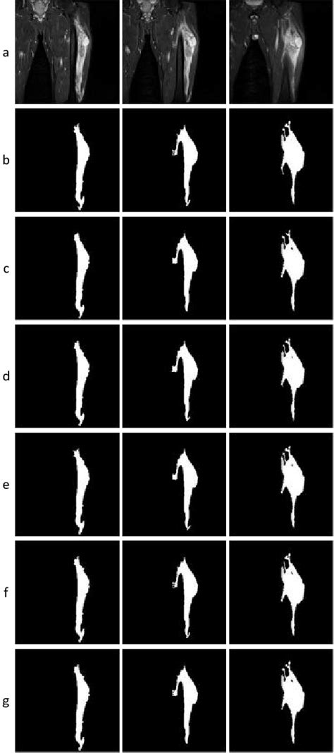 optimized otsu segmentation results of leg images a normal leg image download scientific