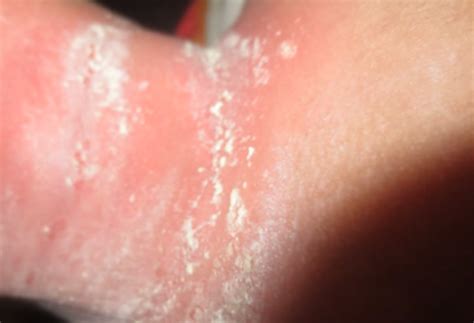 Intertrigo Pictures Rash Symptoms Causes Treatment Hubpages