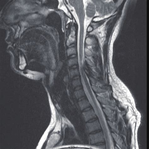 Mri Of Cervical Spine A Sagittal T2 Weighted Images S