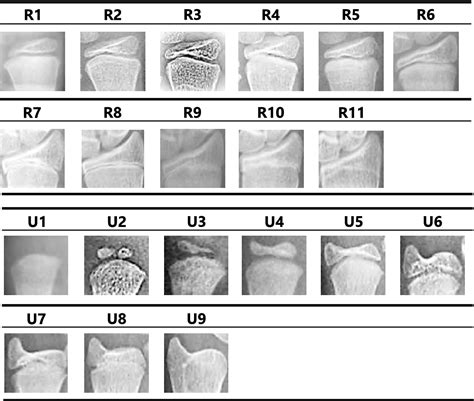 figure 2 from skeletal maturity recognition using a fully automated system with convolutional