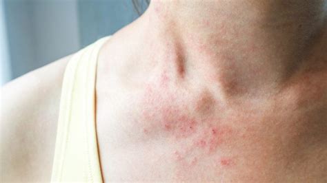 Atopic Vs Contact Dermatitis Whats The Difference Page 12 Entirely Health