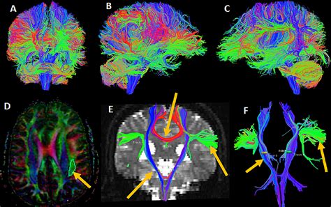 Diffusion Tensor Imaging And Tractography Application In Pre Operative