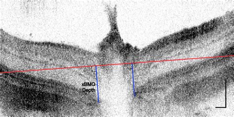 representative onh centered b scan demonstrating the method used to download scientific diagram