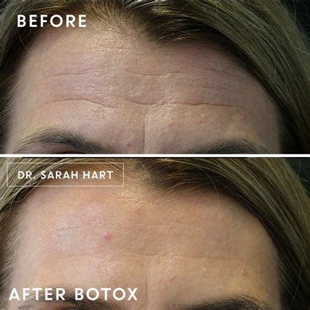 Botox Frown Lines Before And After