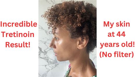 Tretinoin Beginner S Guide Results After 1 Year YouTube