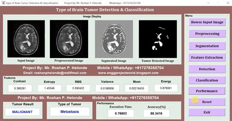 types of brain tumor detection and classification using image processing matlab project source