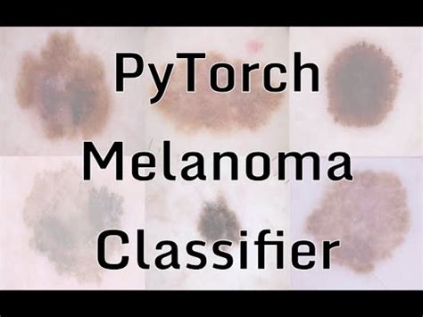 PyTorch Melanoma Classifier 1 Introduction YouTube