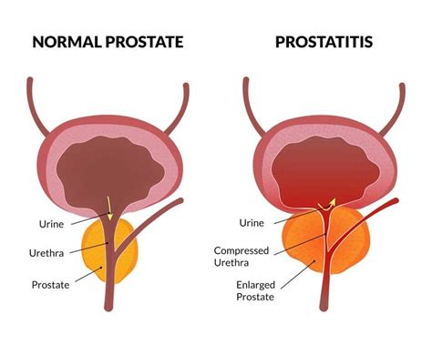 Enlarged Prostate Symptoms Causes And Treatment
