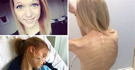 Thinspiration Selfies Almost Killed Me Anorexia Survivors Warning As Mirror Investigation