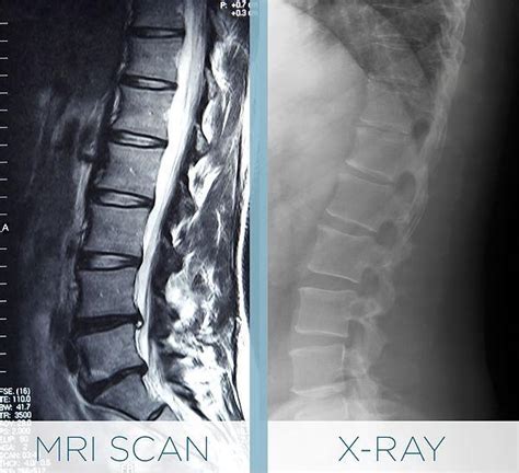 MRI And X Ray What S The Difference Sports Medicine And Joint