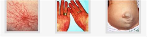 CLINMED Biliary Pancreatic Hepatic Disorders Flashcards Quizlet