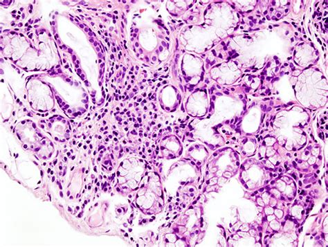 Diagnosing Sjögrens Syndrome With Salivary Gland Ultrasound Research Outreach