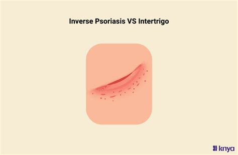 Inverse Psoriasis Vs Intertrigo Learn The Features Of Each Of Them Knya