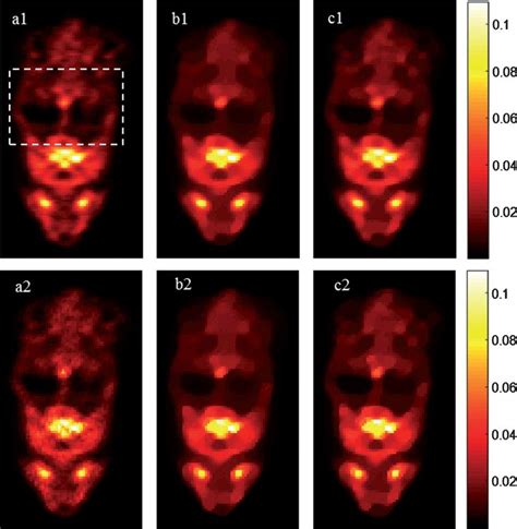 positron emission tomography image reconstruction using feature extraction ios press