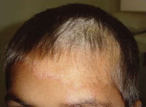 Fungal Scalp Infection Scalp Ringworm Diagnosis And Treatmnet Patient