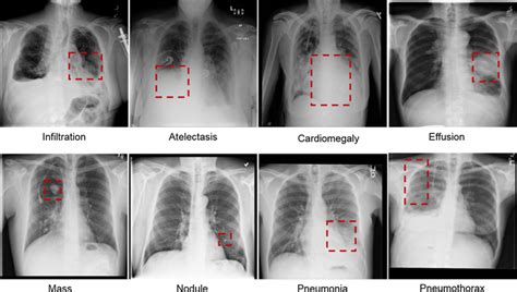 computer aided detection in chest radiography based on artificial intelligence a survey