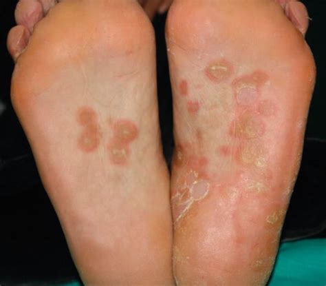 Syphilis Intechopen