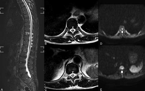 Mri Of Spine A Sagittal Imaging T2 Stir Showing Hyperintensities Download Scientific Diagram