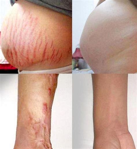 Pin On Stretch Marks On Thighs
